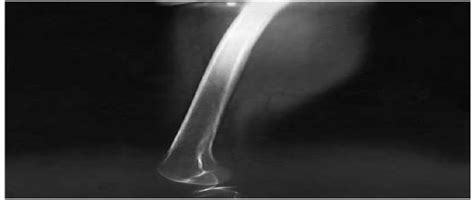 Sciatic Nerve Resection In The Thigh A Functional Evaluatio