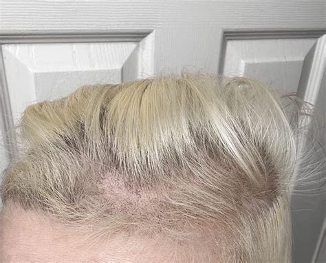 Side Swept Fringe Bangs Rtrichotillomania