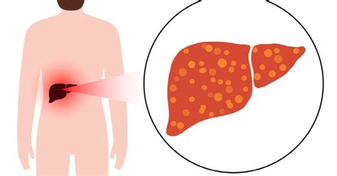 약 없는 지방간 B형간염 치료제 썼더니 개선
