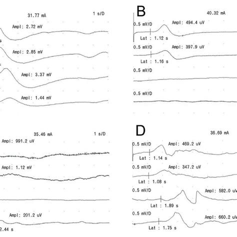 Examples Of Ssr Recordings In A A Normal Subject B A Patient With Download Scientific