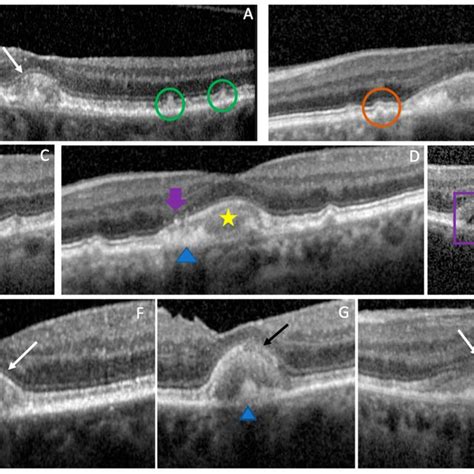 Associated Retinal Lesions Sd Oct B Scans Passing Through The Avls Of