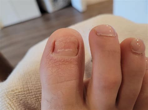 My Struggle And Success With Treating Foottoenail Fungus Rnailfungus