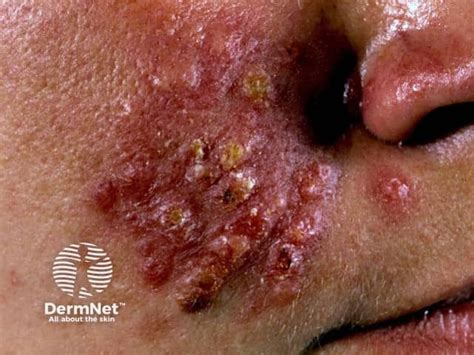 Pyoderma Faciale Rosacea Fulminans