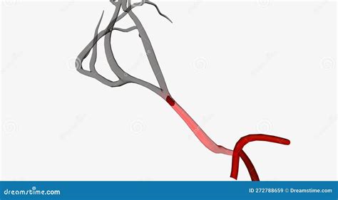 Embolism Blockage In Cerebral Artery Stock Illustration Illustration Of Artery Organ 272788659