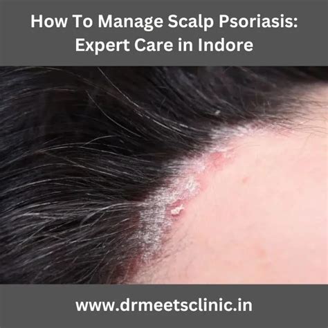 How To Manage Scalp Psoriasis Expert Care In Indore