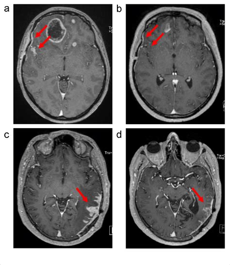 Leptomeningeal Disease From Melanoma—poor Prognosis Despite New