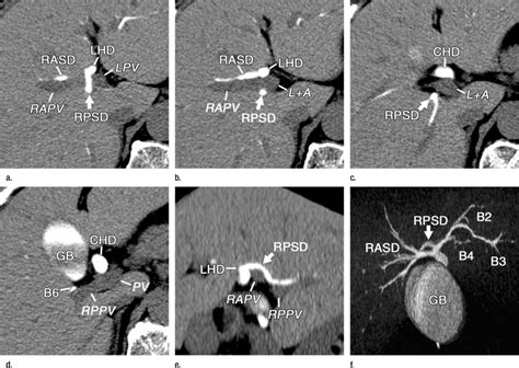 Ct Cholangiograms Of The Portal Vein Variation Associated With The Type Download Scientific