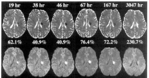 Radiological Findings In Hypoxic Ischaemic Encephalopathy Deranged