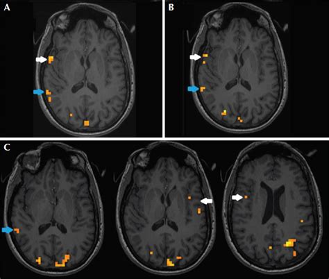 Fmri Activation Maps For Reading Comprehension Tasks In English A