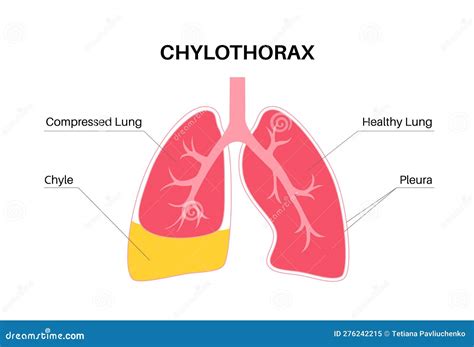 Chylothorax Anatomical Poster Stock Vector Illustration Of Lung Lymphatic 276242215