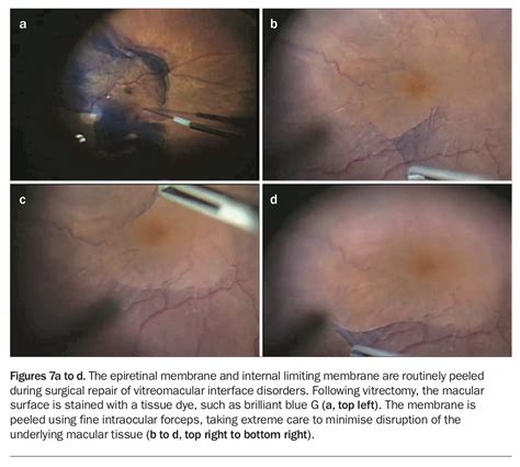 Common Vitreoretinal Interface Disorders Detachments Holes Puckers