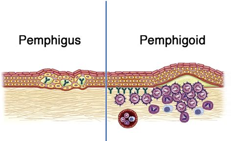 Recent Progresses And Perspectives In Autoimmune Bullous Diseases
