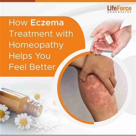 How Eczema Treatment With Homeopathy Helps You Feel Better Best