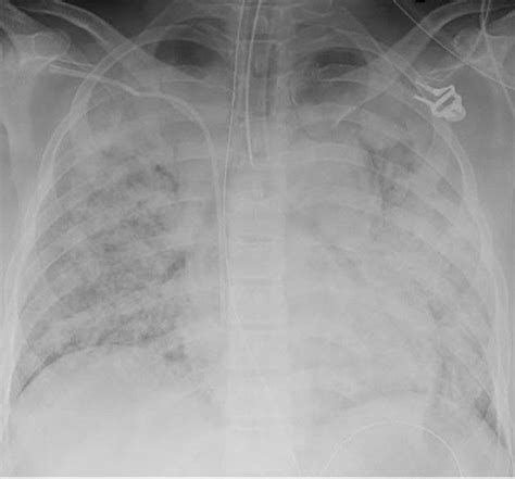 Ards Chest X Ray Usmle Forums