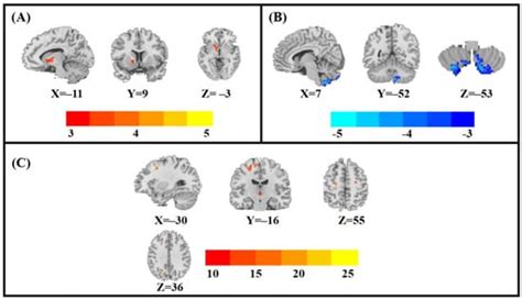 Sex Differences Of The Functional Brain Activity In Treatment Resistant Depression A Resting