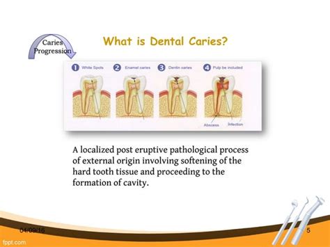 International Caries Detection And Assessment System Icdas Ppt