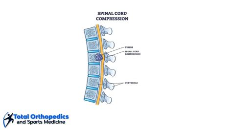 How To Decompress Your Spine Total Ortho Sports Medicine