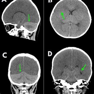 CT Head Showing Diffuse Brain Edema With Hypoxic Ischemic Download