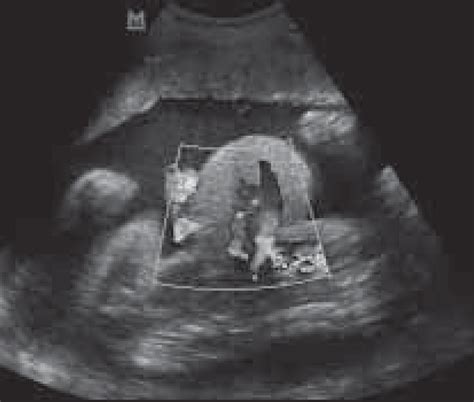 Mild Form Of Ectopia Cordis Download Scientific Diagram