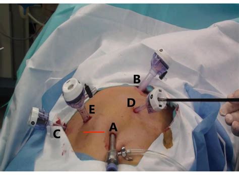 Laparoscopic Anterior Right Hepatectomy A Single Center Experience Text Page