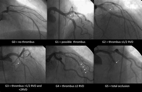 Thrombus Burden Classification Rvd Reference Vessel Diameter The