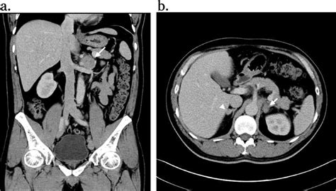 Abdominal Computed Tomography Showed A One 43 Cm Left Para Aortic
