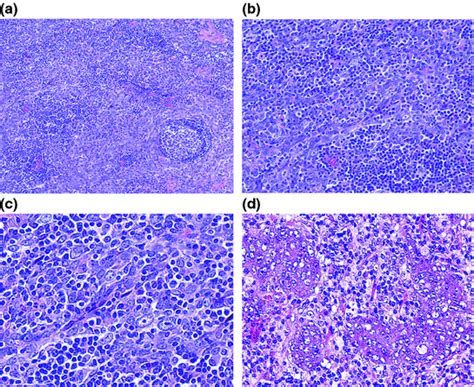 Thymic Epithelial Tumors And Benign Thymic Lesions Basicmedical Key