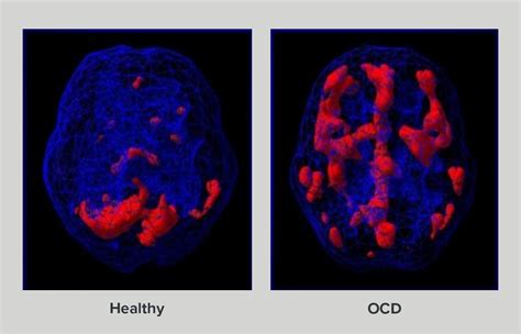 Ocd Theramind Center Of Santa Barbara