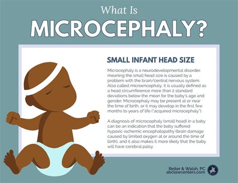 Microcephaly Small Head And Birth Injuries Abc Law Centers Birth