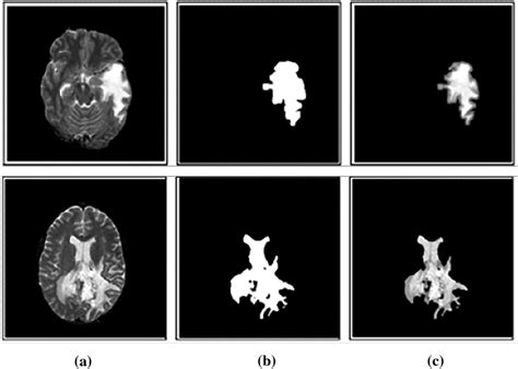 Results For Segmentation Brats 2017 Dataset A Preprocessed B Cvs