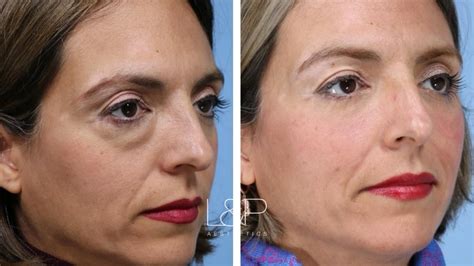 Landp Aesthetics Lower Blepharoplasty Before And After Photos