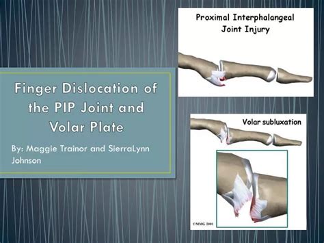Ppt Finger Dislocation Of The Pip Joint And Volar Plate Powerpoint