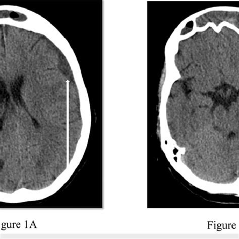 A Loculated Extra Axial Collection Overlying The Left Frontotemporal Download Scientific