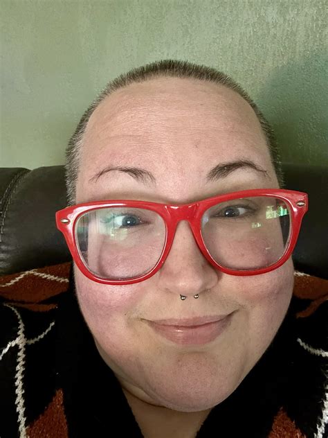 Before And After Both Eyes R Strabismus