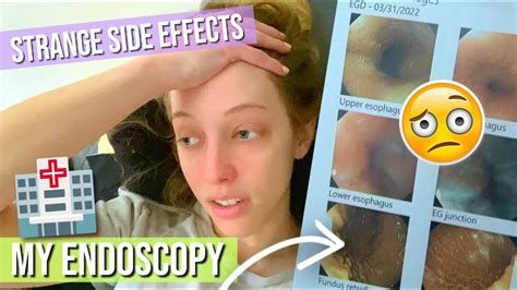 Endoscopy Long Term Side Effects At Jose Hopkins Blog