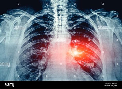Chest X Ray Pneumonia Hi Res Stock Photography And Images Alamy