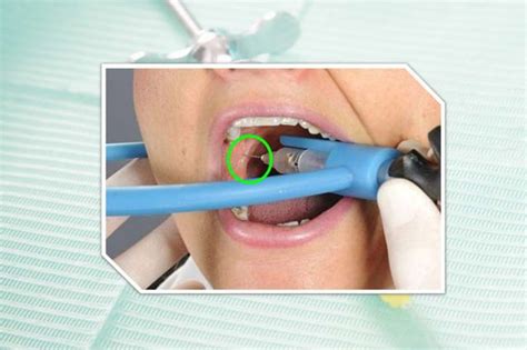 Mandibular Injections PPTX Ear Nose And Throat Conditions Diseases And Conditions