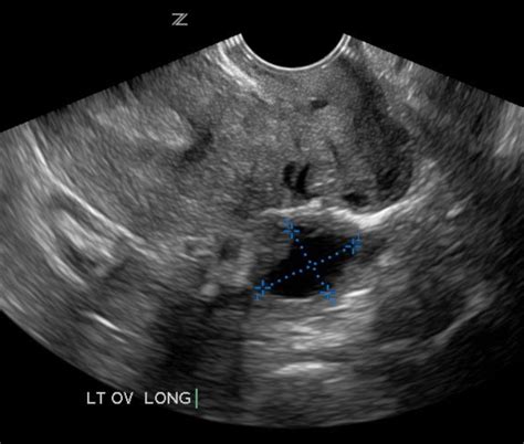 Ultrasound Pictures Of Ovarian Cysts