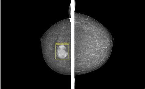 Breast Cancer Digital Mammogram