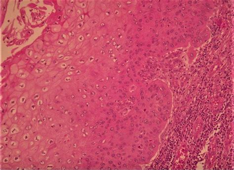 Large Wrinkled Cells With Hyperchromatic Nuclei And Koilocytosis Download Scientific Diagram