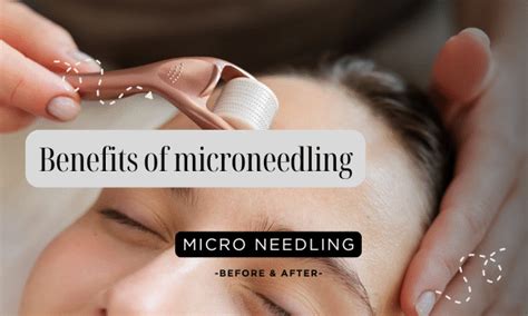 How To Microneedle Scalp