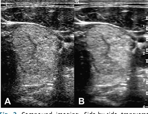 Table 1 From Thyroid Ultrasound Part 1 Technique And Diffuse Disease Semantic Scholar
