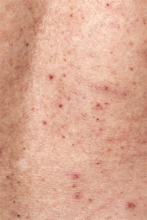 Scabies Rash On Face