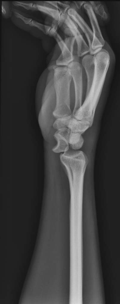 Radiopaedia Case Trans Scaphoid Lunate Dislocation Id Study