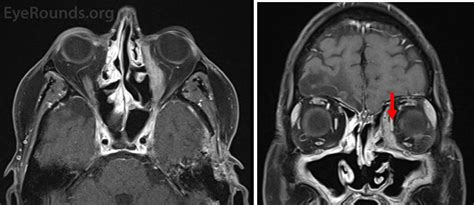 Infraorbital Nerve Mri