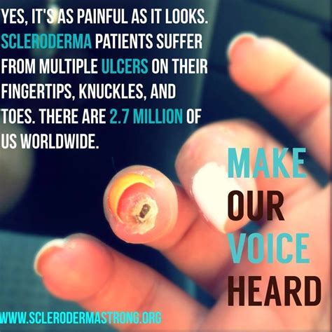 What Is Scleroderma Scleroderma Help End Scleroderma