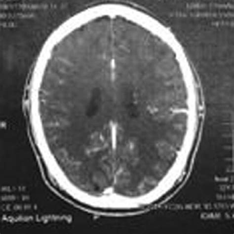 Post Craniotomy Computed Tomography Demonstrating No Injuries To The Download Scientific