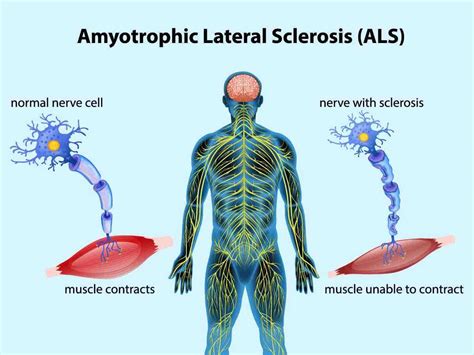 The Future Of Stem Cell Therapy In Als Emedicodiary