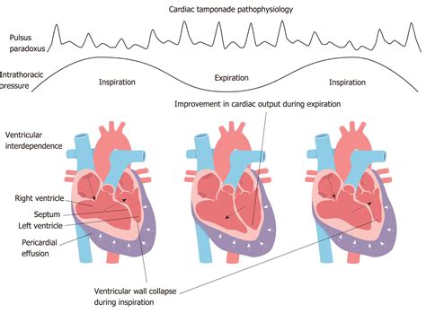 Water Bottleshaped Heart Pericardial Effusion With