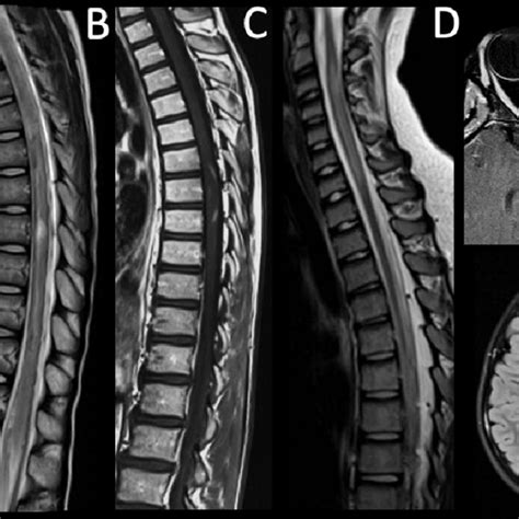 Proposed Diagnostic And Treatment Algorithm For Pediatric NMOSD NMOSD Download Scientific